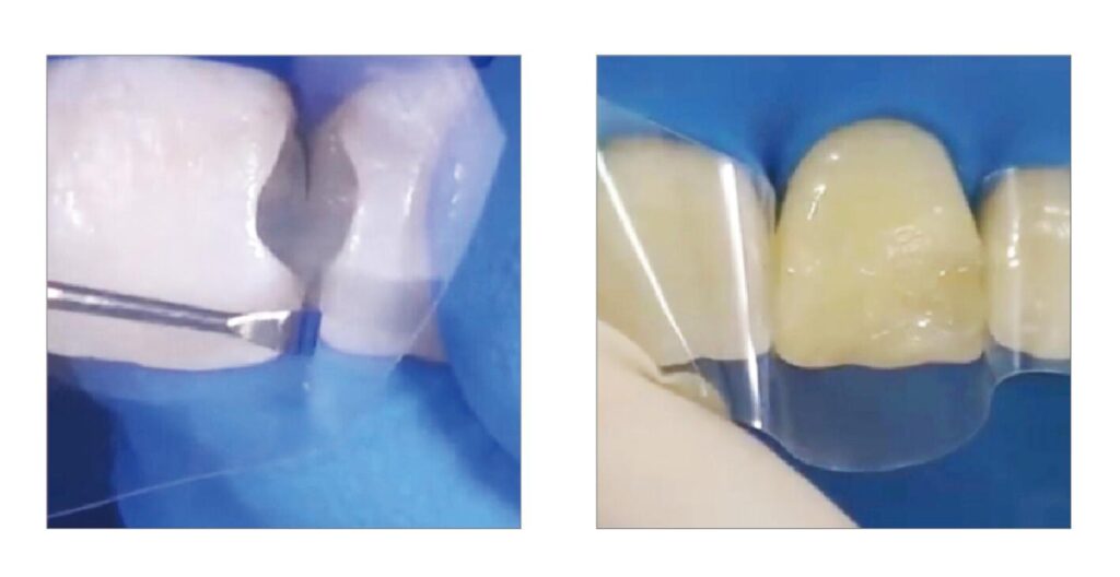 Striproll – THOMSEN DENTAL SUPPLIES